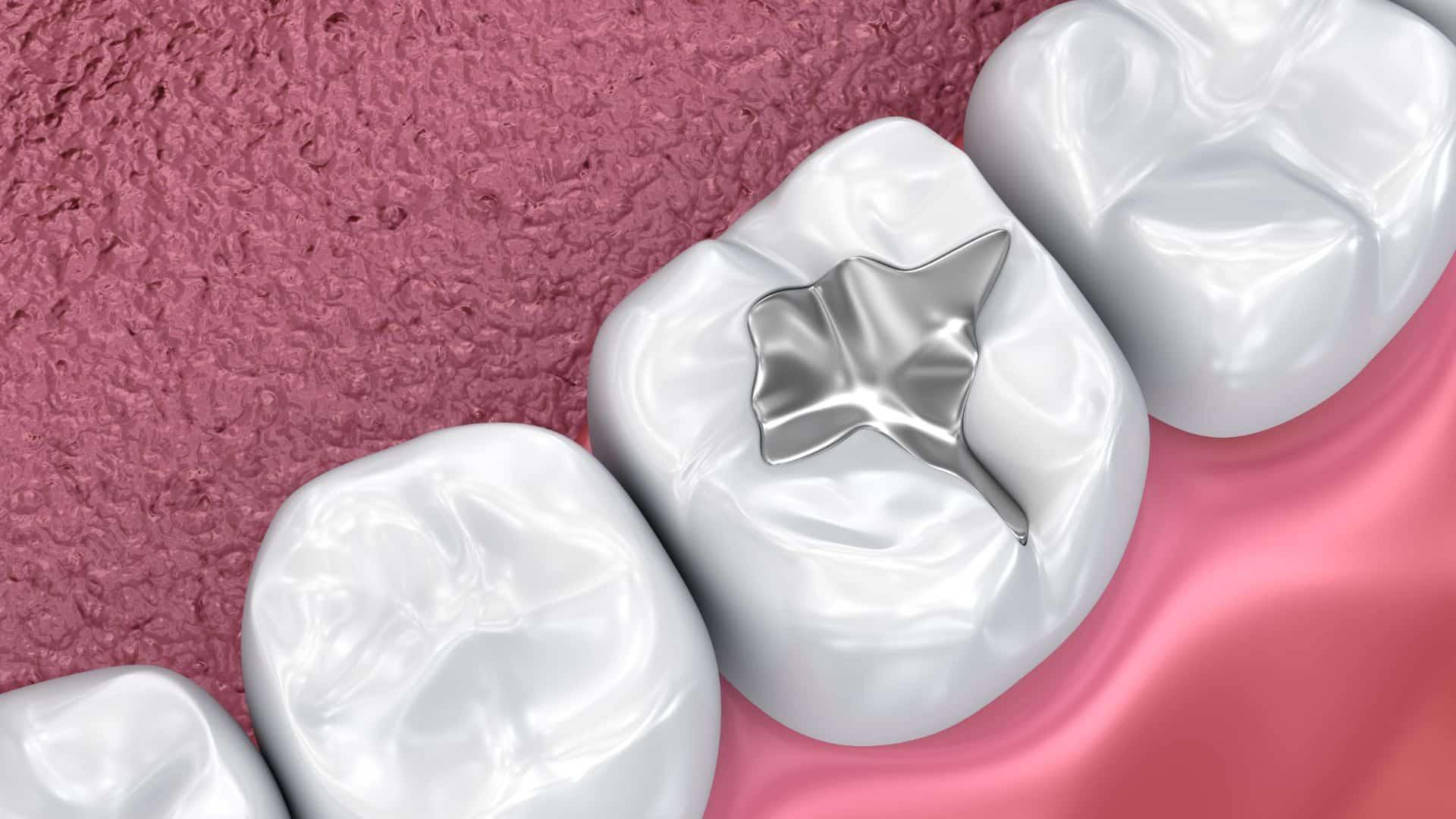 Dental Sealants Mt. Arlington NJ | Arlington Dental