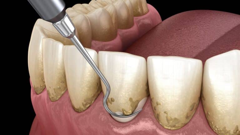 Teeth Cleaning Mount Arlington NJ | Dental Prophylaxis
